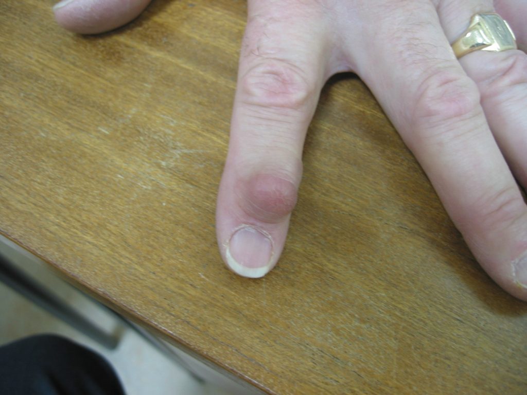 Ganglions | Mr. Michael Woodruff